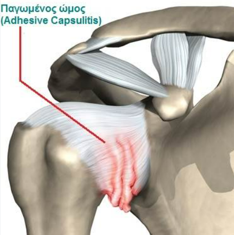 ΠΑΓΩΜΕΝΟΣ ΩΜΟΣ (FROZEN SHOULDER) | Απόστολος Προδρομίδης