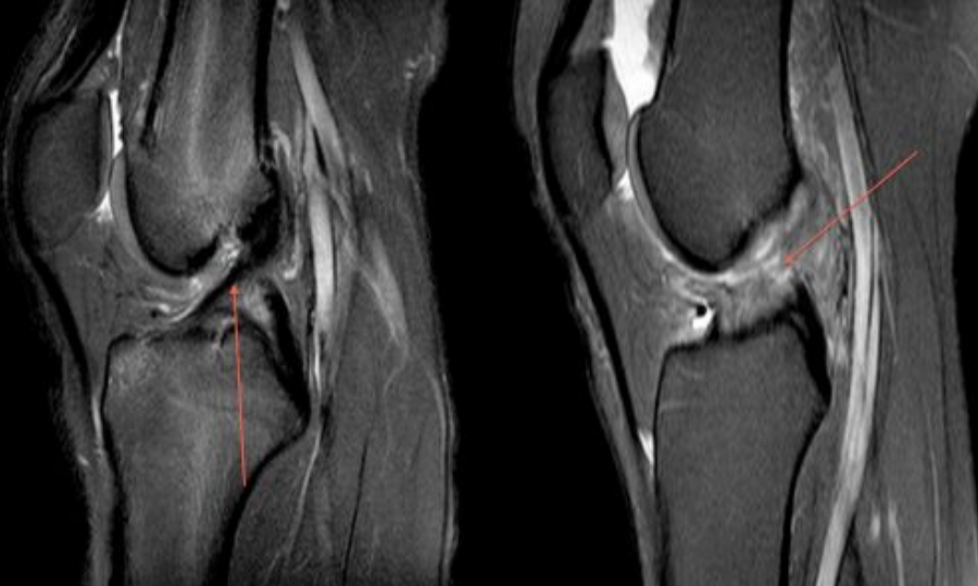 ΡΗΞΗ ΠΡΟΣΘΙΟΥ ΧΙΑΣΤΟΥ ΣΥΝΔΕΣΜΟΥ | Απόστολος Προδρομίδης